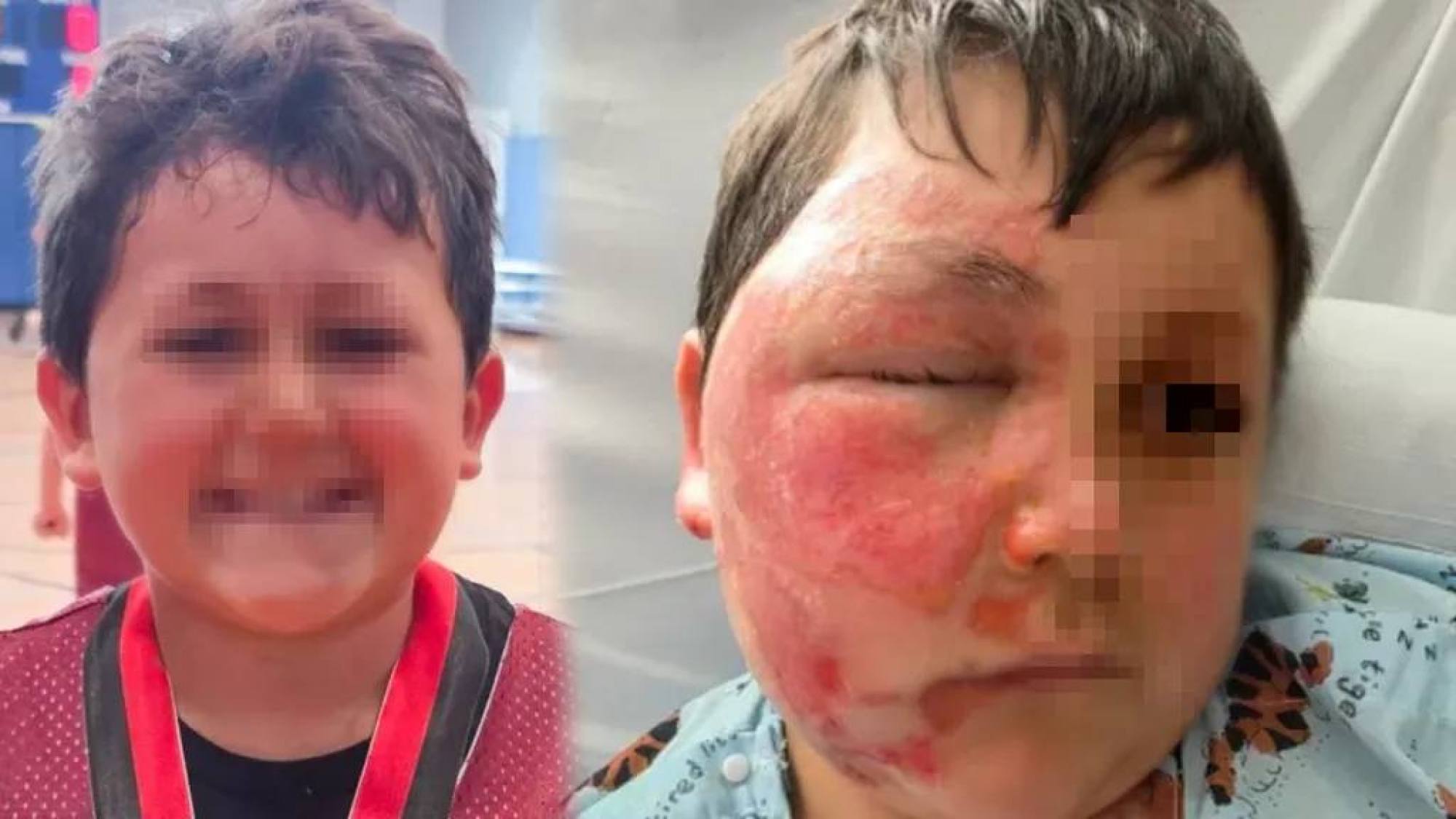Niño de 9 años sufre quemaduras por reto viral de TikTok